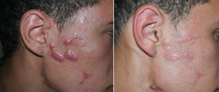 Chirurgie Chéloïde : chirurgie des cicatrices par Hichem Mahmoud